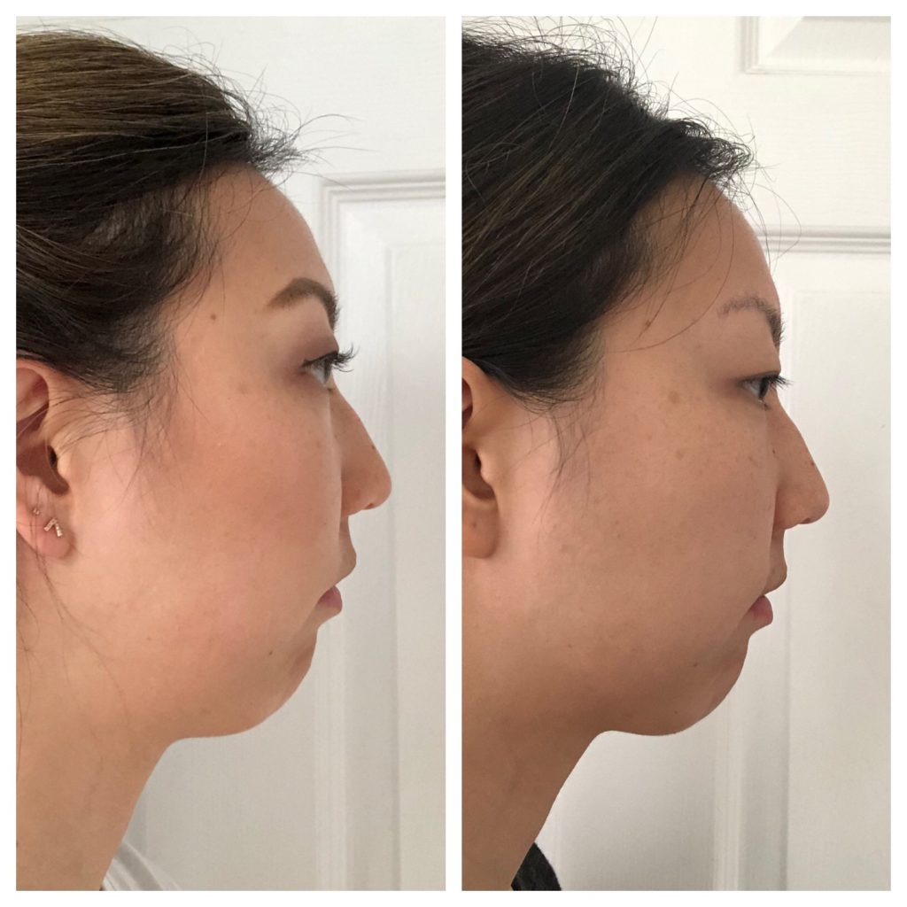 My Experience Getting Kybella – TREND ENVY