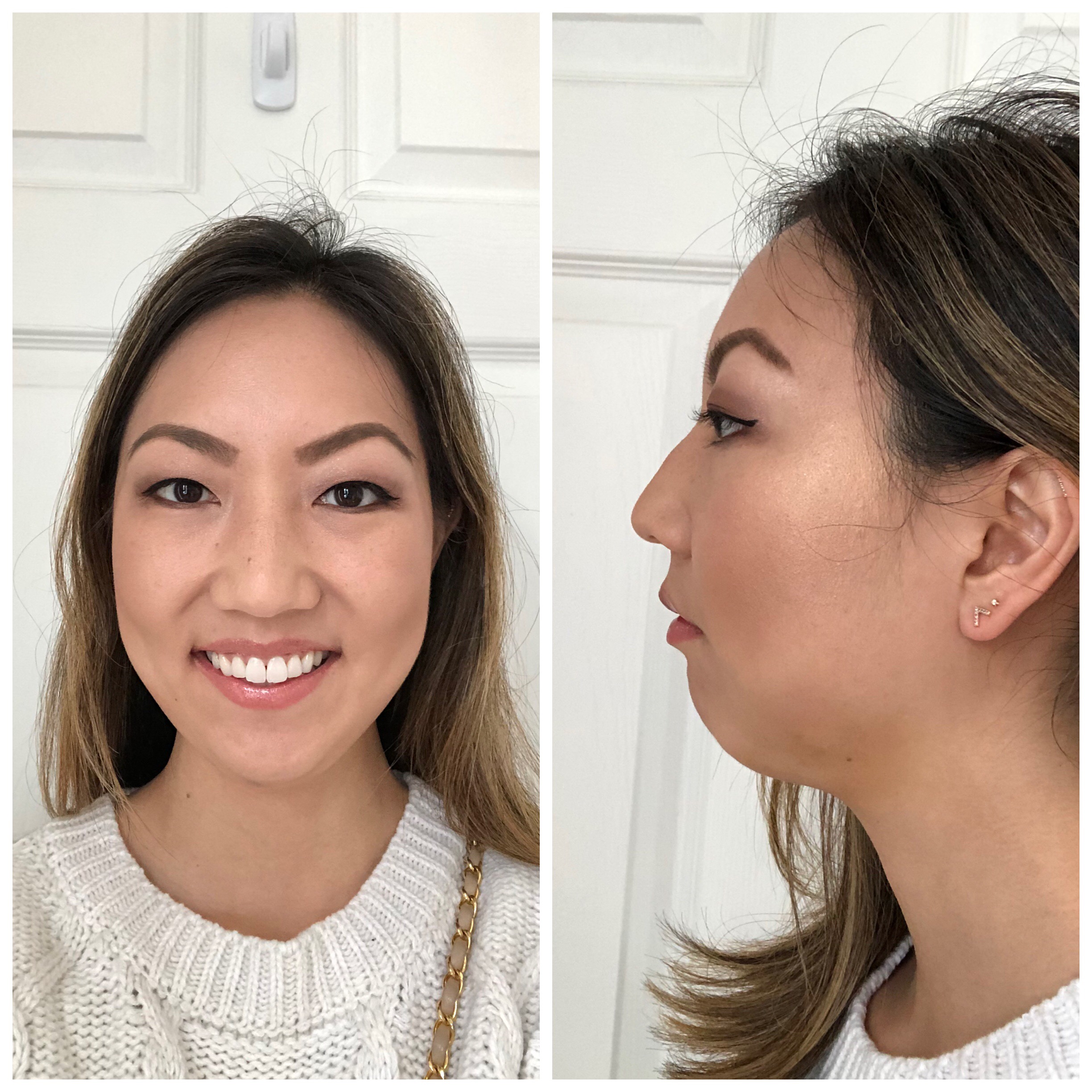 My Experience Getting Kybella – TREND ENVY